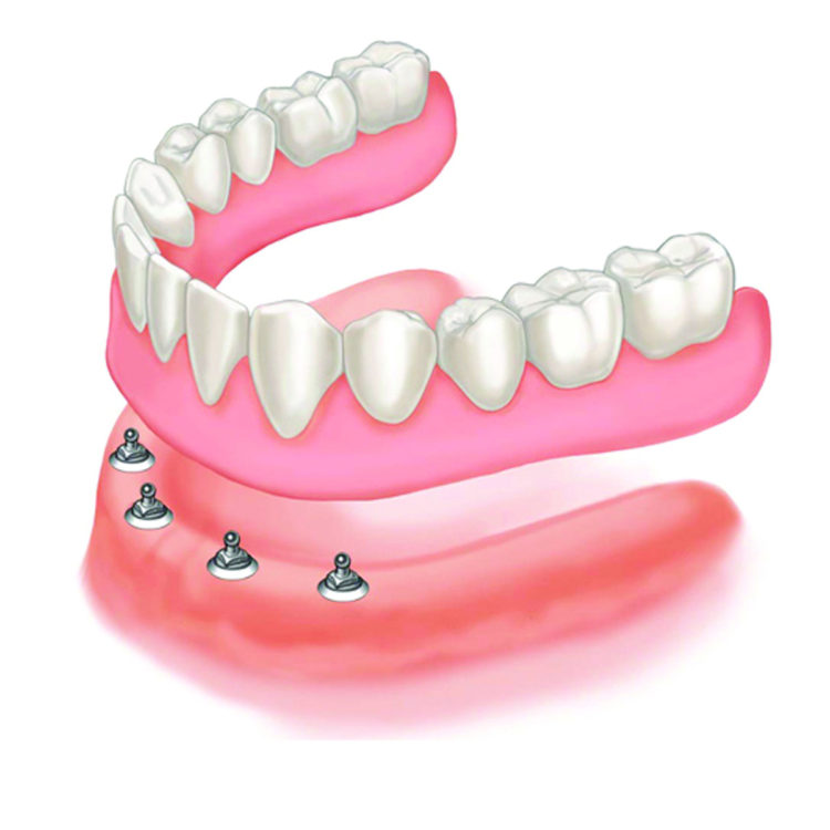 Removable dentures, Prosthetic restorations - Dental Clinic Crete